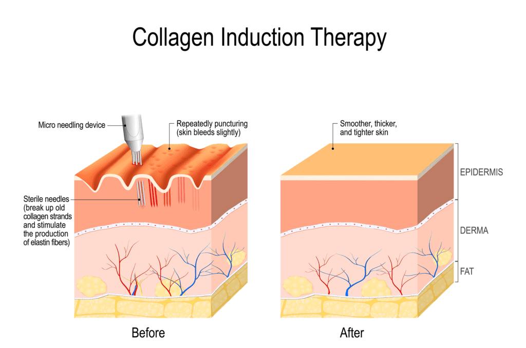 Microneedling in new jersey for Skin Texture and Glow Boost